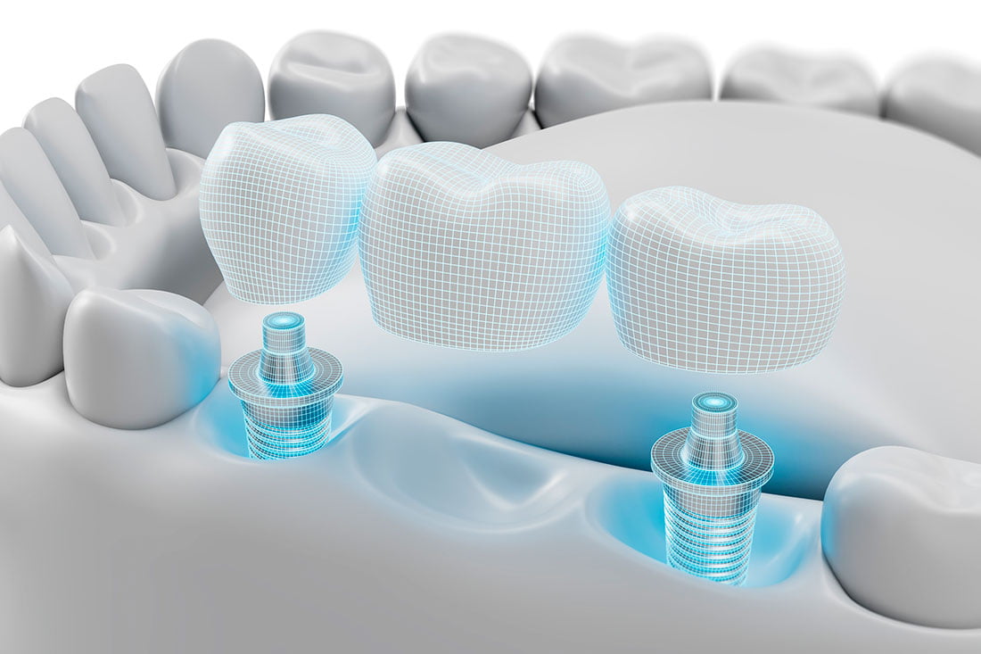 ᐈ Dental Tooth Bridges in Bayview, ON | Bayview Smile Centre